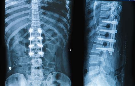 Lumbar Adjacent Segment Disease