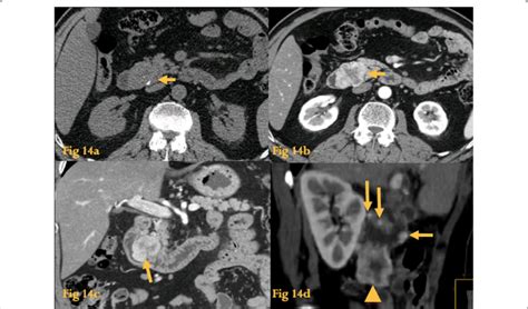 Gist Unenhanced Abdominal Ct A Shows A Heterogeneous Soft Tissue Download Scientific Diagram