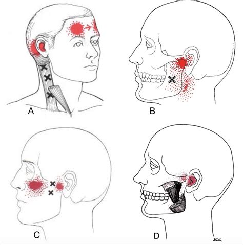 Your Frustrating Ear Pressure May Actually Be Your Tmj The Jaw Therapist