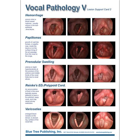 Vocal Pathology 5 Chart Set Lesions