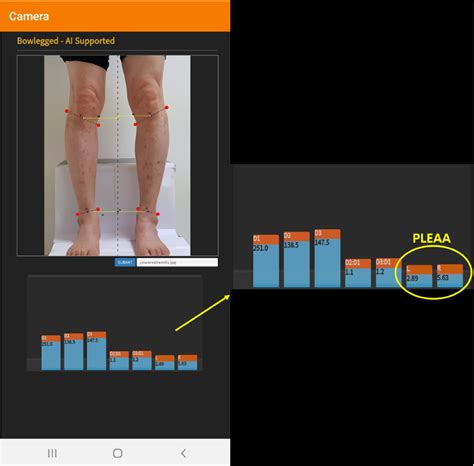 Figure 1 From Measurement Of Lower Extremity Alignment Using A Smartphone Application Semantic