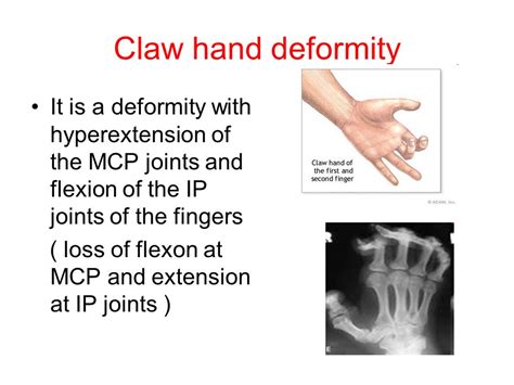 Peripheral Nerve Injuries Ppt Video Online Download