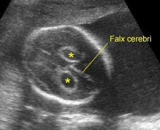Choroid Plexus Cyst Department Of Obstetrics And Gynecology Faculty Of Medicine Chiang Mai