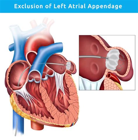 Exclusion Of Left Atrial Appendage Professor Kevin P Walsh