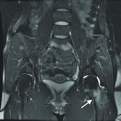 Coronal T2 Weighted Mri Scan Of The Left Hip Of A 16 Year Old Female