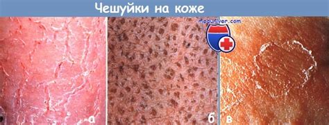 Вторичные элементы кожи Чешуйки и их причины