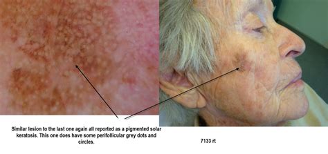 Dermoscopy Made Simple Solar Keratosis