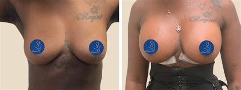 Extra Large Breast Augmentation Before And After