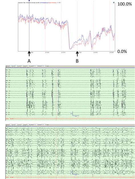 Quantitative Eeg Analysis Basics Neupsy Key