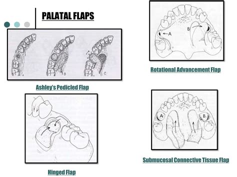 17 Maxillary Sinus Antrum Of Highmore Surgical Anatomy Pptx