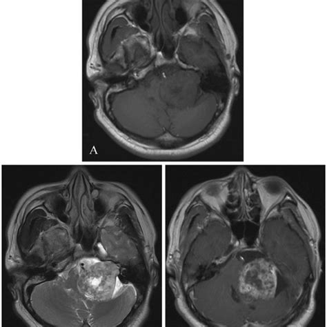 Preoperative Cta Images Showing Calcification And The Intracranial Download Scientific Diagram