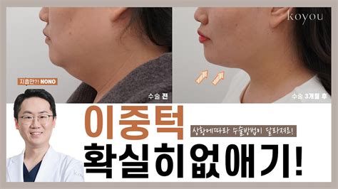 이중턱 없애는 수술 이중턱지방흡입 목리프팅근육묶기 수술에 대해 알아보자고유성형외과 조건원장 Youtube