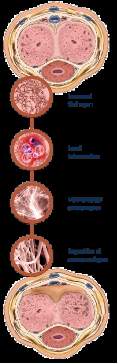 Peyronies Disease Xiaflex® Collagenase Clostridium Histolyticum