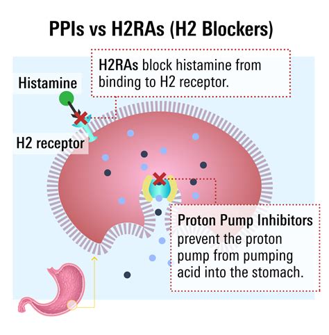 Acid Related Conditions Gerd And Peptic Ulcer Disease