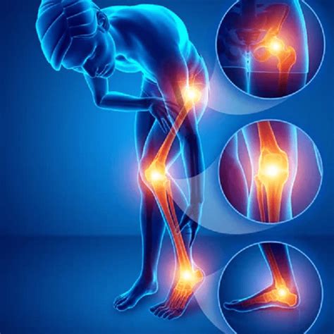 نکروز آواسکولار مرکز تصویربرداری پزشکی دکتر قائمیان