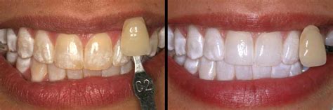 Professional Teeth Whitening Philadelphia Center City Dr Richard Eidelson Dds