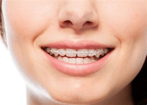 Silver Braces Bands Amazing Smiles Orthodontics