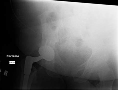 Invagination Of Elevated Lip Liner Preventing Reduction Of Dislocated