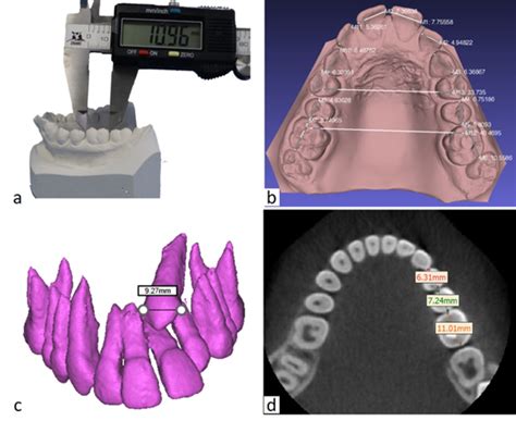 A Mesiodistal Tooth Width Measurement In Plaster Model Using A Digital