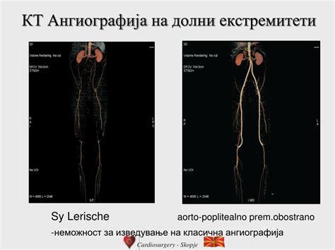 Ppt 64 слојна компјутеризирана томографија на периферни крвни садови Powerpoint Presentation