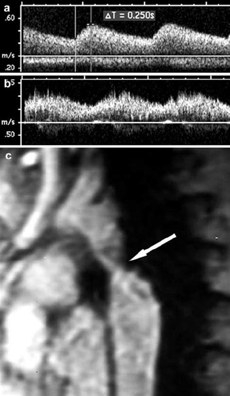 Hypertension And Aortic Coarctation In An Asymptomatic Teenage Girl Download Scientific