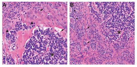 Case 4 A Metastatic Neuroendocrine Tumor Composed Hyperchromatic
