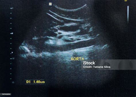 대동맥 초음파스캔 복 부의 의료 이미징 대동맥을 보였다 초음파에 대한 스톡 사진 및 기타 이미지 초음파 X 레이 건강