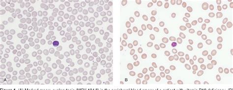 Megaloblastic Anemia Peripheral Smear