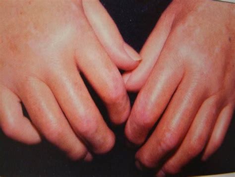 Scleroderma Rheumatology Medbullets Step 23