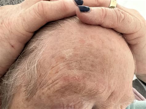 Forehead Dry Redblotchy Skin Rskin