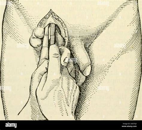 Modern Surgery General And Operative Stricted Bowel Within It Has Been Forced Throughthe