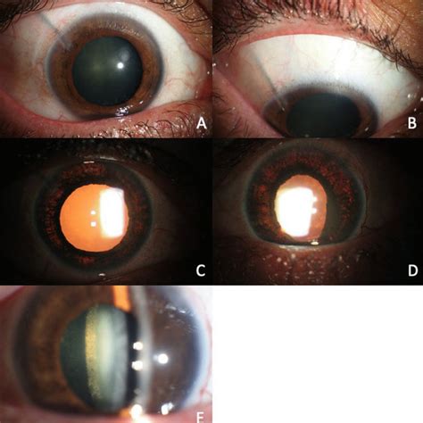 A Case 2 Iris Nodules Seen At The Inferior Pupillary Border Of The Download Scientific