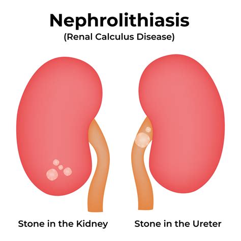 Nephrolithiasis Renal Calculus Disease Science Design Illustration Diagram 48042342 Vector Art