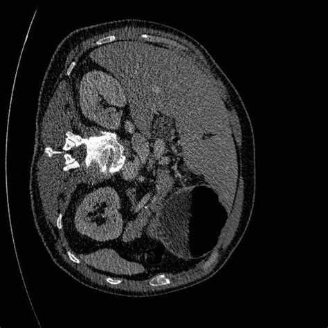 Object Segmentation Instance Segmentation Model By Classification Brain Tumor