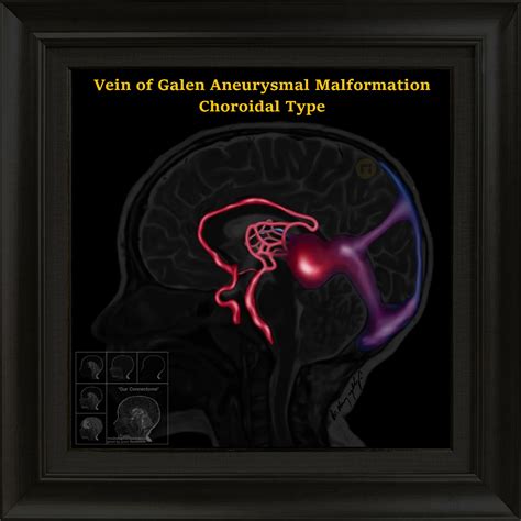 Pediatrikradyoloji P598 Cochlear Aperture Sensorineural Hearing Loss 🔕 The Cochlear