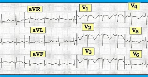 ECG Interpretation ECG Blog 119 Anterior T Wave Inversion Ischemia Long QT Acute PE