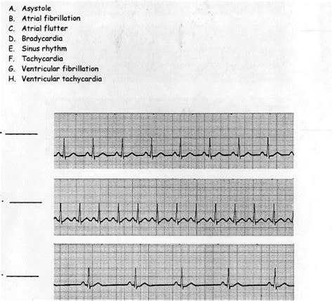 Could You Please Answer And Give Explanation For The Heart Condition Asystole Atrial