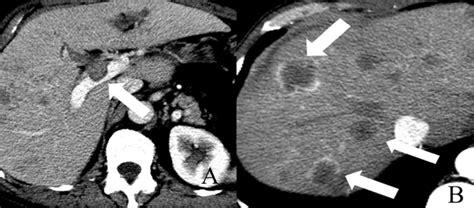 Cholangiocarcinoma Radiology