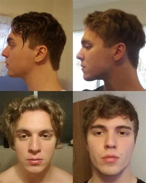 Proper Mewing Tongue Posture Before And After Adopting Correct Resting