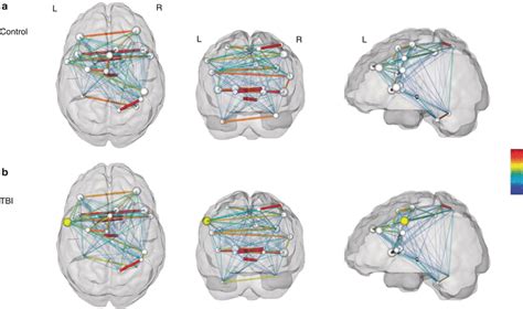 Plasticity In Fmri And Dti Radiology Key