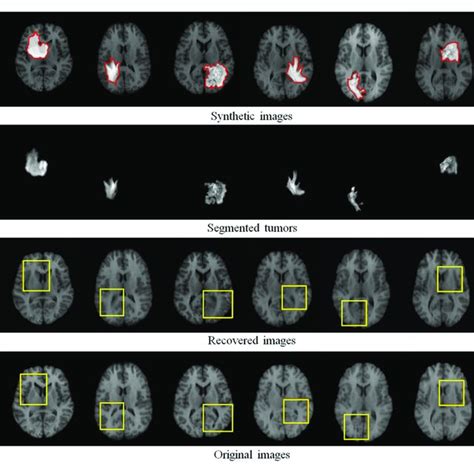 Recovery And Segmentation Of A Synthetic Mr Brain Tumor Images B