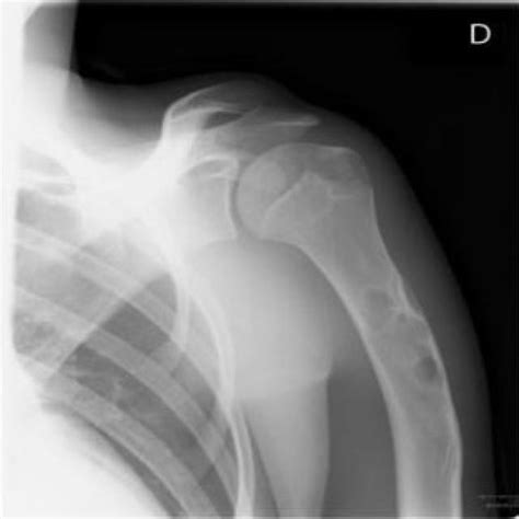 Bone X Rays Object Detection Model By Pracainzynierska