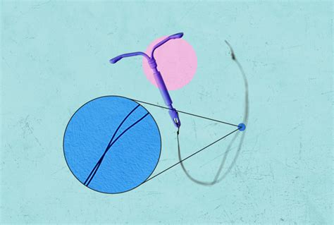 Why It S Important To Check Your IUD Strings