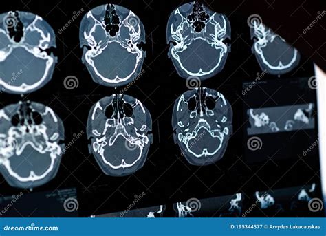 Brain CT Scan X Ray Film Image Brain Stock Image Image Of Basal Angiogram 195344377