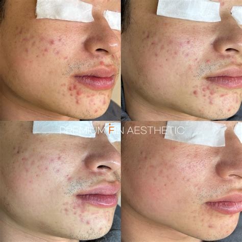 일산피부관리 여드름 문제성피부 전문 핀에스테틱 일산점 대표원장 📌빨간 화농성 여드름 개선 과정 ⚠️문제성 피부는 평범한 피부 관리보다 훨씬 심도있는 상담과 히스토리