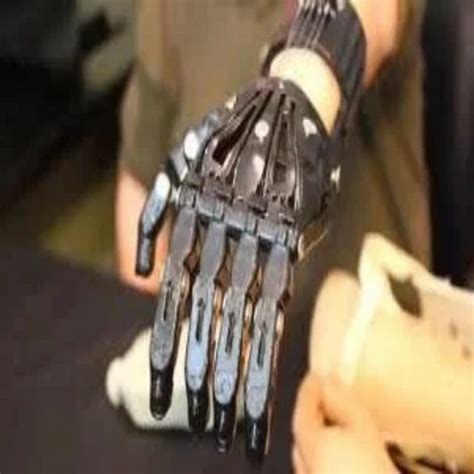 Ilimb Myoelectric Prosthetic Hand For Personal Below The Elbow At ₹ 98000 Piece In Lucknow
