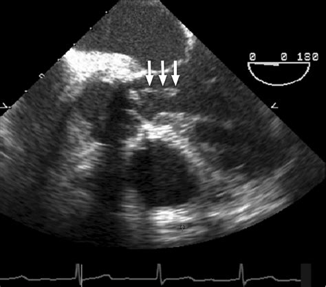 Transesophageal Echocardiogram On The 1st Hospital Admission Shows A