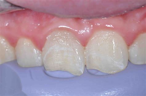 Class Four Composite Restoration Lee Ann Brady Dmds Dental Blog
