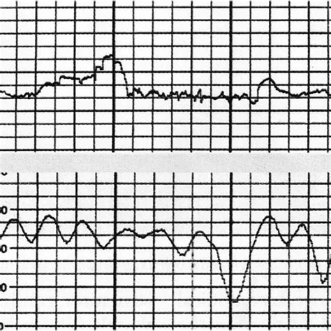 Sinusoidal Fetal Heart Rate Tracing Following Rupture Of A Vasa Previa