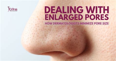 Dealing With Enlarged Pores How Dermatologists Minimize Pore Size For Clearer Skin Skin Solutionz